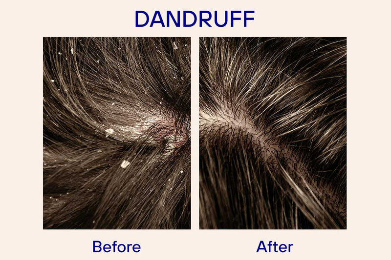Anti Dandruff Shampoo – The Powder Shampoo